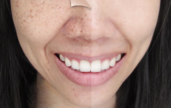 Whitening Injection in Korea: Quick Facts Towards Snow White and ...