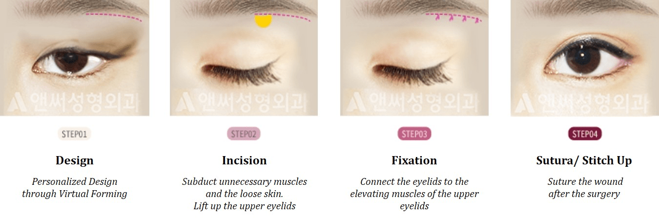 Eyebrow Lift - Quick Facts to Read Towards Perfect Eyebrows! - Seoul ...