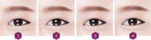 Canthoplasty - What Must I Know Before Getting Canthoplasty Surgery ...