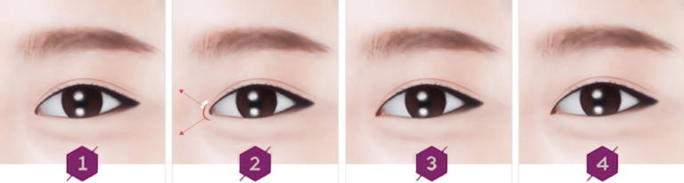 Canthoplasty - What Must I Know Before Getting Canthoplasty Surgery ...