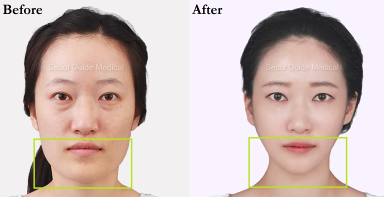 Square Jaw Reduction: Procedure Steps, Recovery Time, Costs, and Much ...