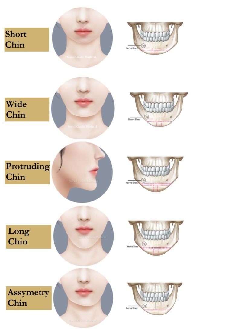 Genioplasty: Your Guide To Chin Surgery In South Korea - Seoul Guide ...