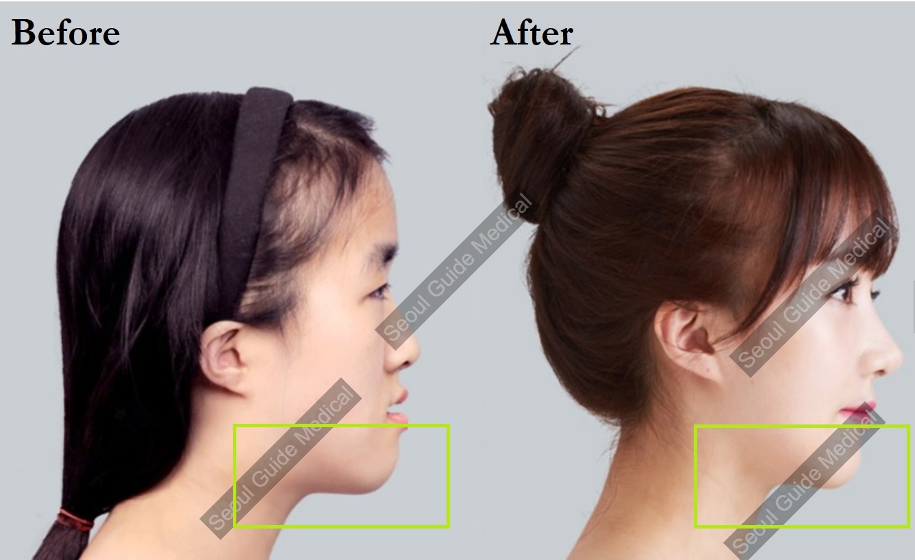 Genioplasty: Your Guide To Chin Surgery In South Korea - Seoul Guide ...