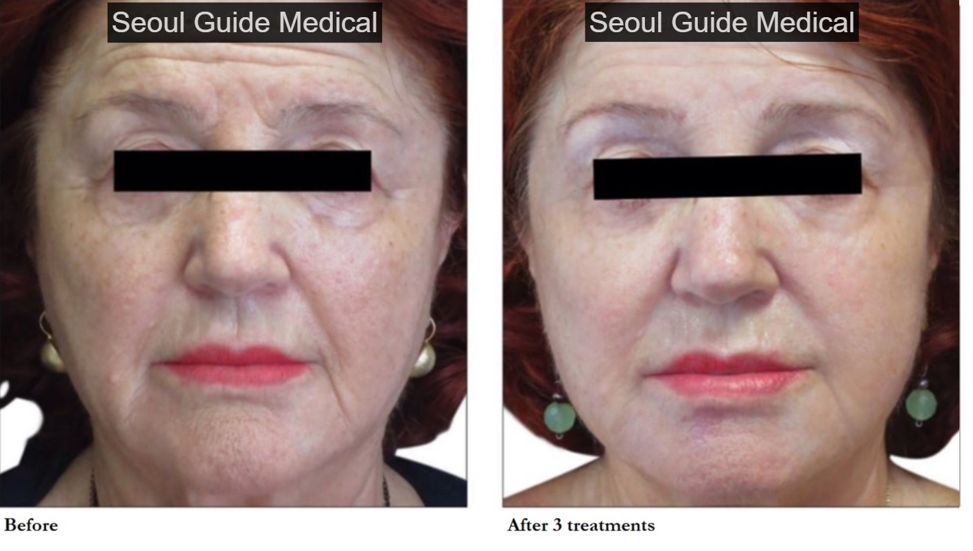 Glowing God(dess) Package: How To Get Glowing Skin - Seoul Guide Medical