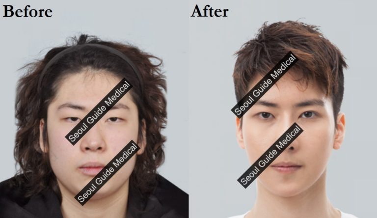 Your Guide to Getting Zygoma Reduction in Korea - Seoul Guide Medical