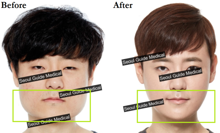 Square Jaw Reduction: Procedure Steps, Recovery Time, Costs, and Much ...