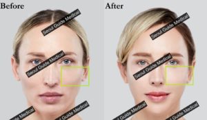 Your Guide to Getting Zygoma Reduction in Korea - Seoul Guide Medical