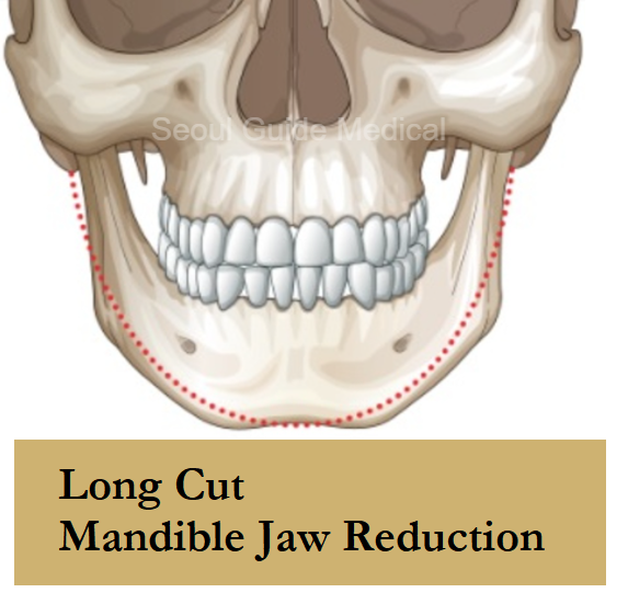 Square Jaw Reduction: Procedure Steps, Recovery Time, Costs, and Much ...