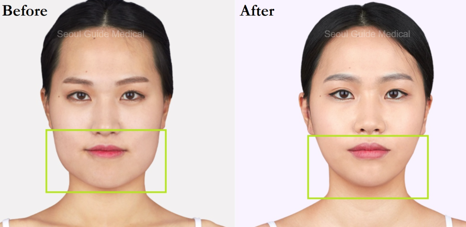 Square Jaw Reduction: Procedure Steps, Recovery Time, Costs, and Much ...