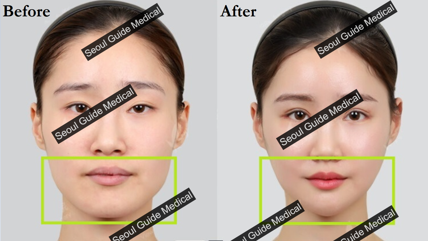 Square Jaw Reduction: Procedure Steps, Recovery Time, Costs, and Much ...