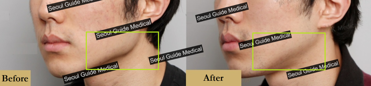Square Jaw Reduction: Procedure Steps, Recovery Time, Costs, and Much ...