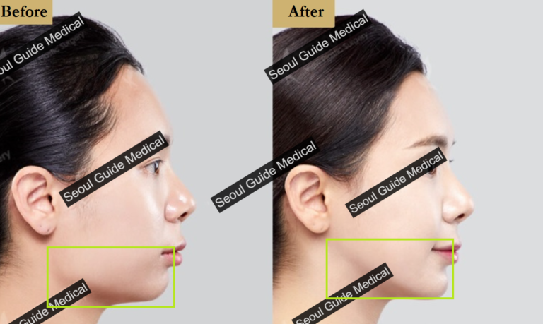 Square Jaw Reduction: Procedure Steps, Recovery Time, Costs, and Much ...