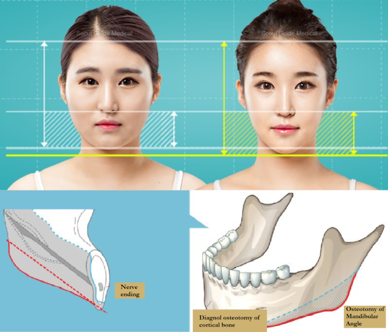 Square Jaw Reduction: Procedure Steps, Recovery Time, Costs, and Much ...