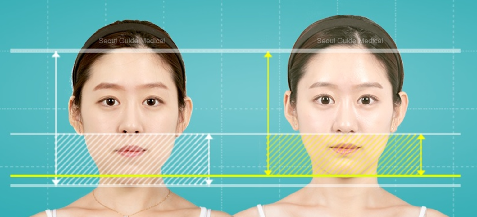Square Jaw Reduction: Procedure Steps, Recovery Time, Costs, and Much ...