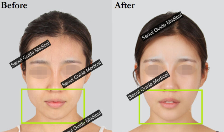 Square Jaw Reduction: Procedure Steps, Recovery Time, Costs, and Much ...