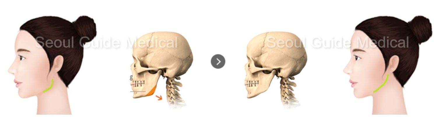 Square Jaw Reduction: Procedure Steps, Recovery Time, Costs, and Much ...