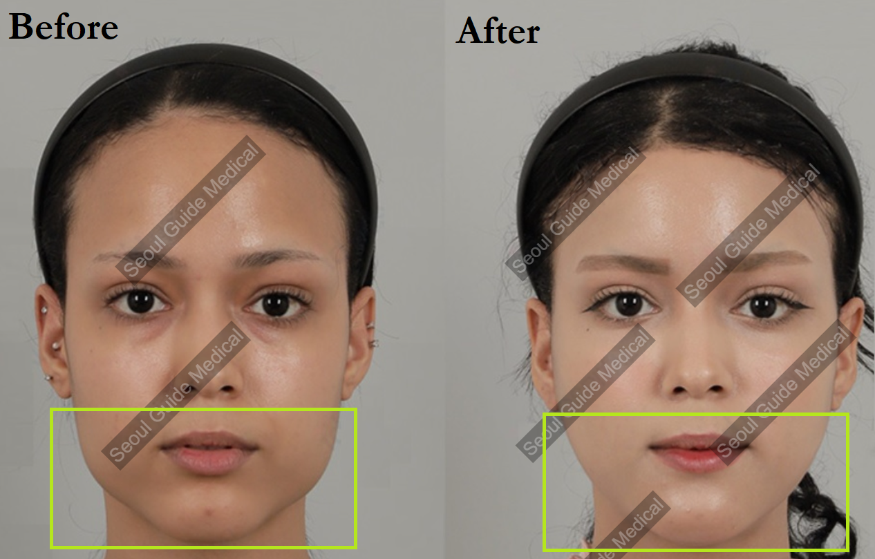 Square Jaw Reduction: Procedure Steps, Recovery Time, Costs, and Much ...