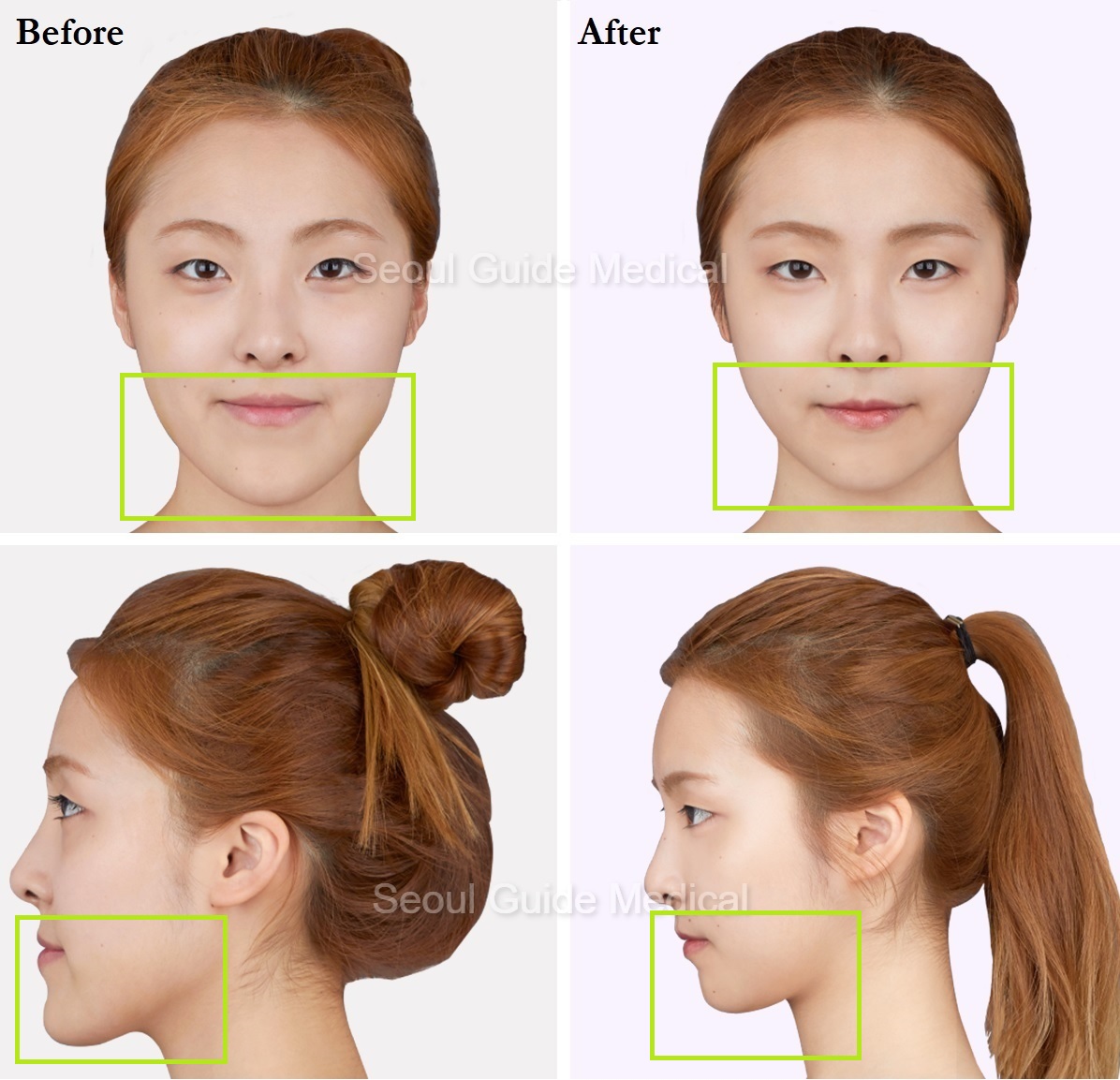 Before And After Double Jaw Surgery - Seoul Guide Medical